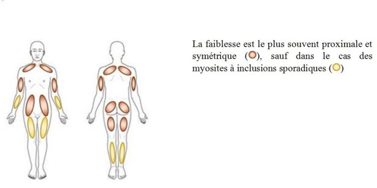 Myopathies inflammatoires – CRMR des maladies auto-immunes de ...